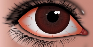 Your guide to conjunctivitis (pink eye) | Lenstore.co.uk