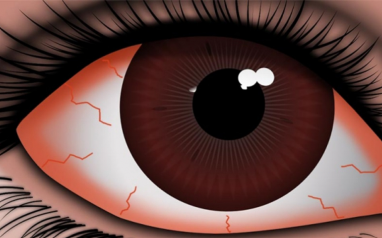 Mucus fishing: the risks and symptoms | Lenstore.co.uk